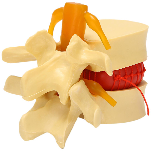 Lumbarvirvelmodell Anatomisk Ryggrad Lumbar Disc Herniation Anatomi ...